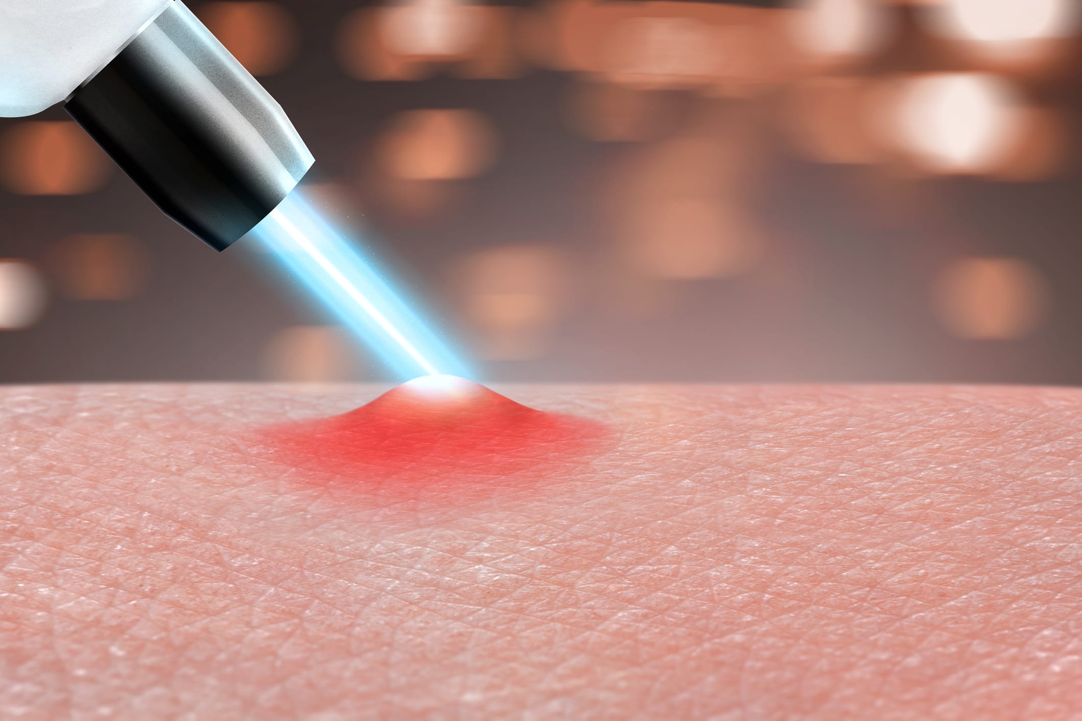 Laser and Light Therapies for Treating Chronic Skin Conditions ...